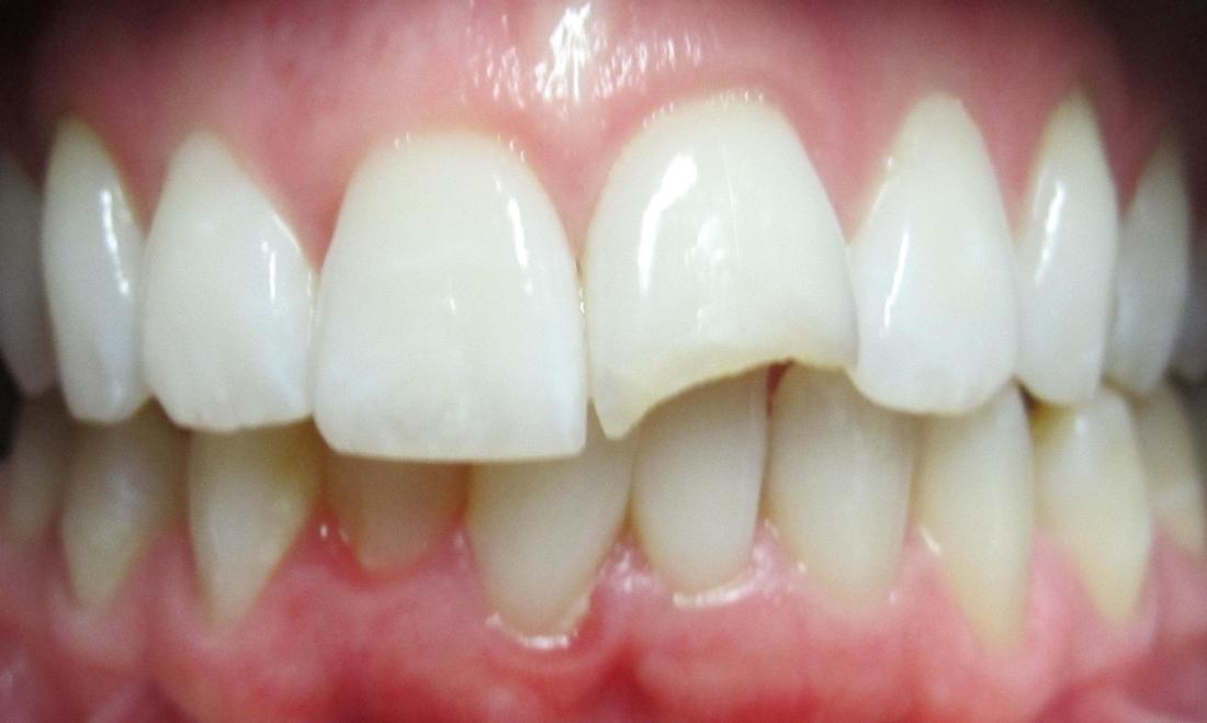 Porcelain Crown To Fix Broken Tooth | Dental Crown Temple TX